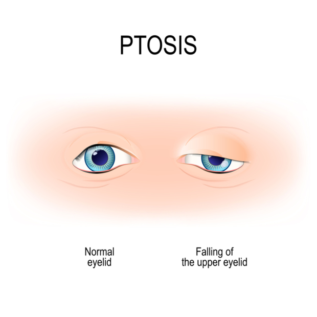 Know More About Ptosis Surgery In Singapore With These Important Facts